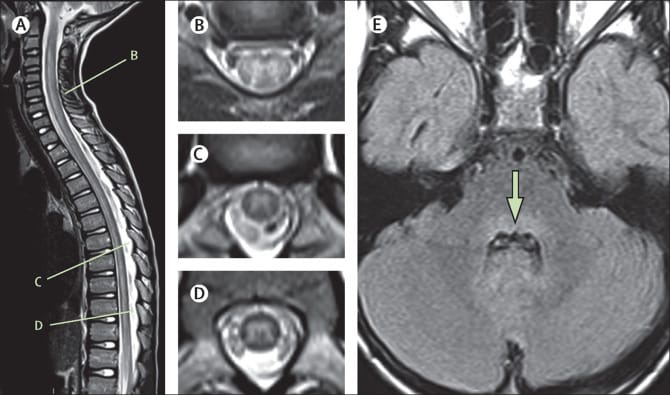 Acute Flaccid Myelitis (AFM): Symptoms, Treatment, and Prevention ...